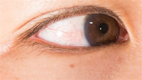 Pinguecula Removal Chelmsford Top Eye Clinic In Essex