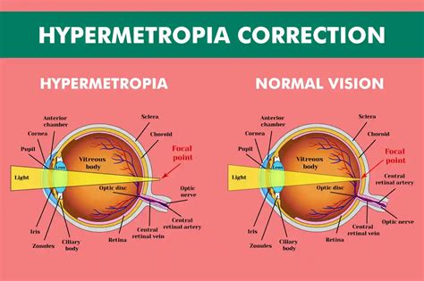 Hypermetropia Correction Techniques For Better Vision