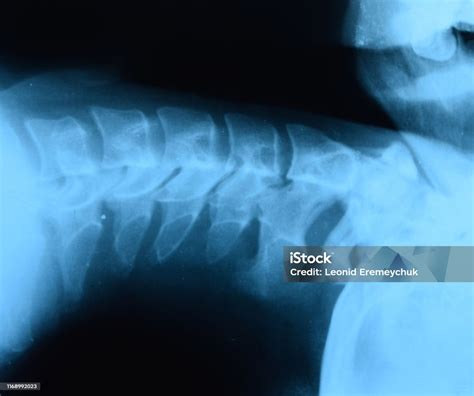 자궁 경부 척추의 X 선 자궁 경부 척추의 X 선 이미지 Ankylosing Spondylitis에 대한 스톡 사진 및 기타