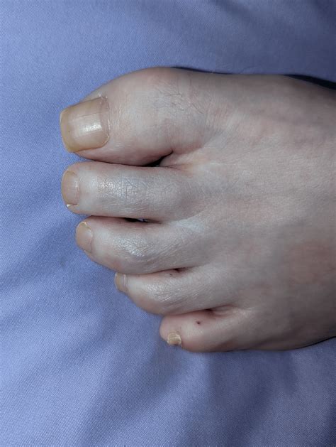 Left Big Toe But Also Toe Next To It R Footfunction