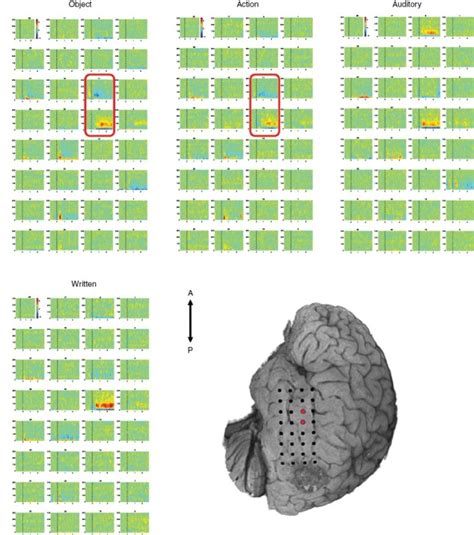 Intraoperative Language Mapping Guided By Real Time Visualization Of