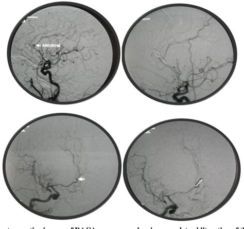 Outcome Analysis Of Distal Anterior Cerebral Artery Aneurysms With And