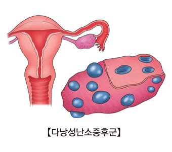 다낭성 난소 증후군 질환백과 의료정보 건강정보 서울아산병원