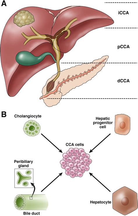 Pathogenesis Diagnosis And Management Of Cholangiocarcinoma Gastroenterology