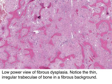 Pathology Outlines Fibrous Dysplasia