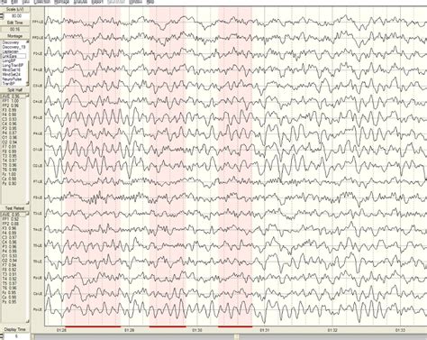 Diagnosis Of Attention Deficit Hyperactivity Disorder Using Non‐linear Analysis Of The Eeg