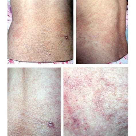 Lesions On The Posterior And Anterior Trunk Show An Download