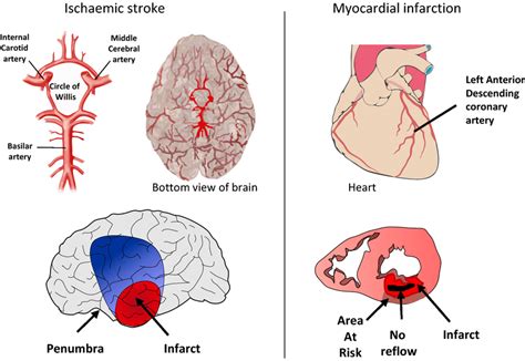 Pdf Endovascular Occlusion Of The Posterior Cerebral