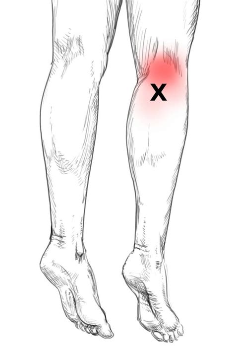 Popliteus Pain And Trigger Points