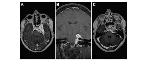 Stereotactic Mri Of The Brain A An Axial Cut Depicting The Size Of
