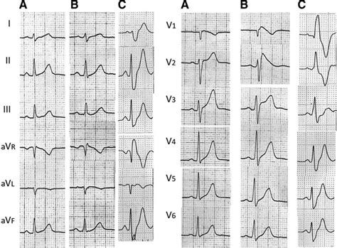 Brugada Syndrome Behind Complete Right Bundle Branch Block Circulation