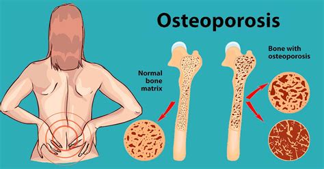 Osteoporosis Treatment 13 Ways To Stop Bone Loss Before Its Too Late