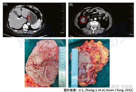 胃癌、肠癌、前列腺癌，患这么多癌症的他究竟惹了谁？ 知乎
