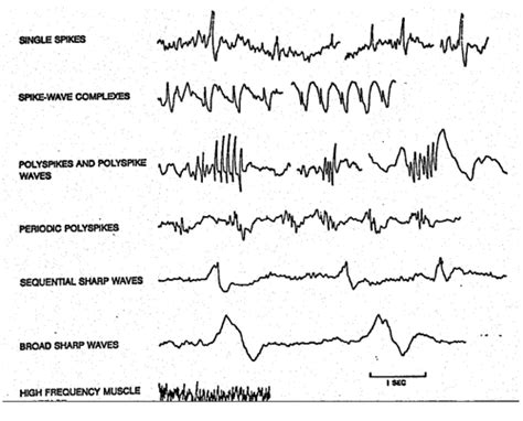 Abnormal Eeg Flashcards Quizlet