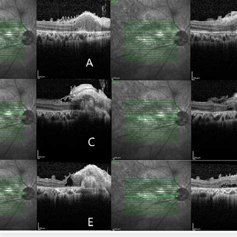Right Eye Fibrosis At The Papillomacular Bundle With Traction On The