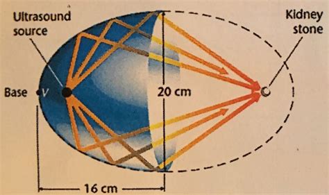 Solved A Lithotripter Is A Device Used For Breaking Up Chegg Com