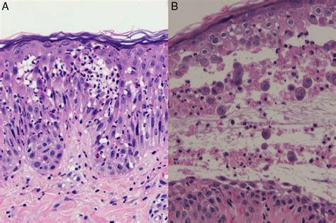 Pemphigus Herpetiformis With Progression To Pemphigus Foliaceus A Case