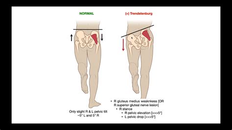 Unterschied Trendelenburg Duchenne Ndaix
