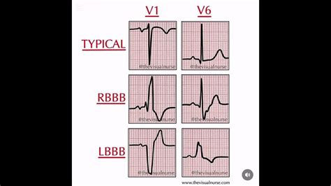 Rbbb And Lbbb Youtube