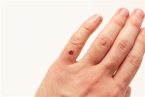 7 Ways Get Rid Of Unwanted Warts A2z Healthy