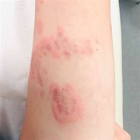 Annular Arciform Polycyclic Erythematous Lesions Download
