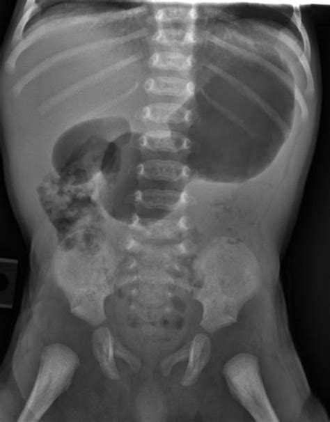 Pyloric Stenosis Xray