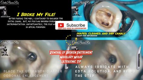 REMOVAL OF BROKEN FRACTURED ENDODONTIC ROTARY FILE IN ROOT CANAL USING