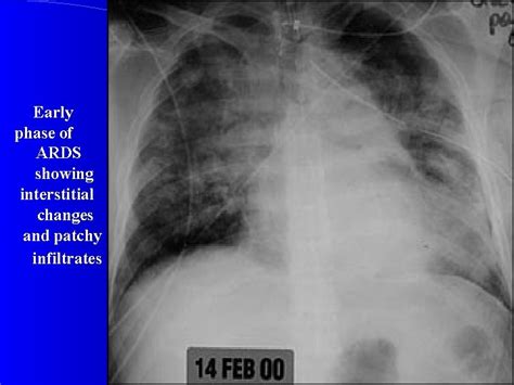 Acute Respiratory Distress Syndrome Ards Done By Ammar