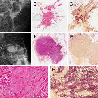 Histological And Radiological Images Of Screen Detected And Interval