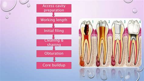 Root Canal Preparation Techniques Pptx Dental Health Diseases And Conditions