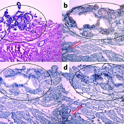 A Prostate Cancer Gleason Scored 6 Showing Architectural And Download Scientific Diagram