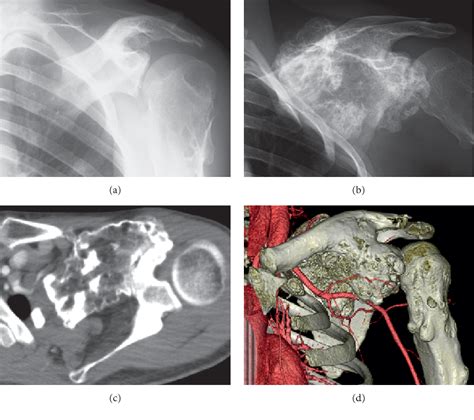 Figure 1 From Secondary Chondrosarcoma Presenting With Symptoms Similar To Thoracic Outlet