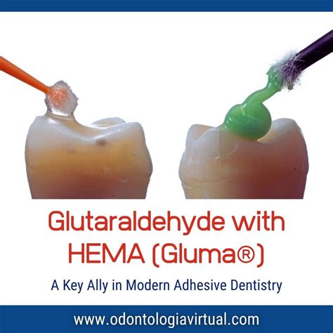 Glutaraldehyde With Hema Gluma® A Key Ally In Modern Adhesive Dentistry