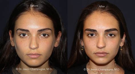 Eyebrow Hair Transplantation Beverly Hills Plastic Surgeon Dr