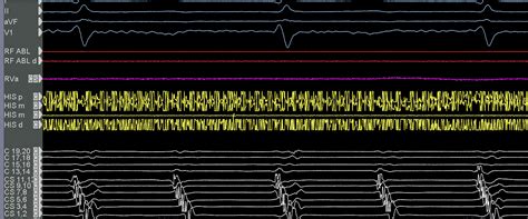 SVT Case Study EP Essentials