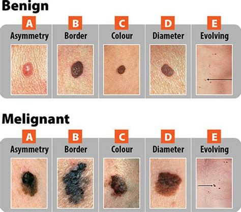 Cancerous Mole Scalp