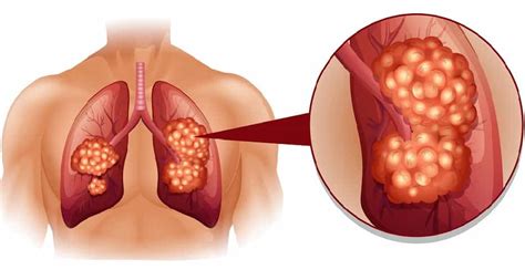 Foods That Can Reduce Risk Of Lung Tumor Admac Oncology