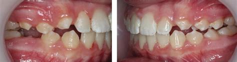 Treatment For Class I Malocclusion Pocket Dentistry