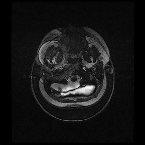 Cochlear Incomplete Partition With Lateral Semicircular Canal Dysplasia