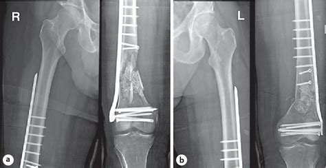 Figure 2 From Bilateral Concomitant Open Distal Femur Fractures Associated With Bilateral
