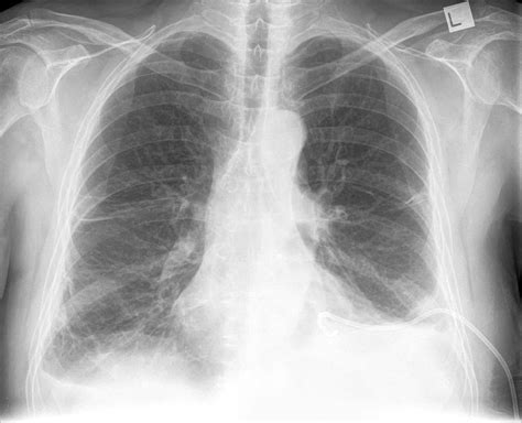 Chest X Ray Showing Left Sided Pleural Effusion With A Small Apical