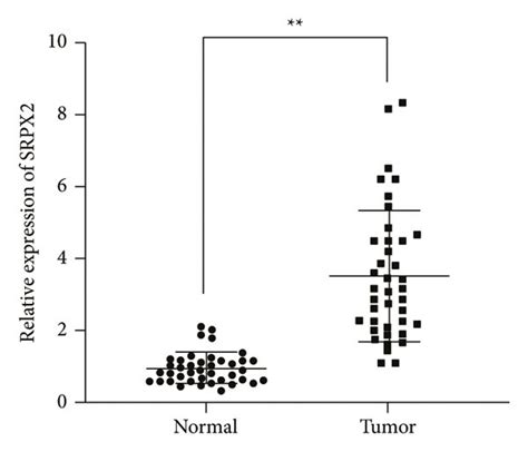 SRPX2 is elevated in PTC. (a) SRPX2 expression in PTC cells. (b) SRPX2 ...