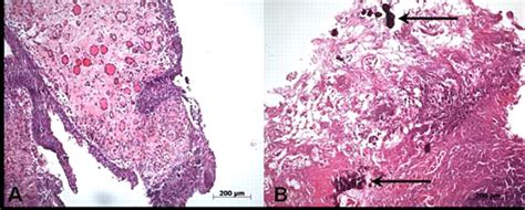 Alkaline Encrusted Pyelitis And Cystitis An Easily Missed And Life Threatening Urinary