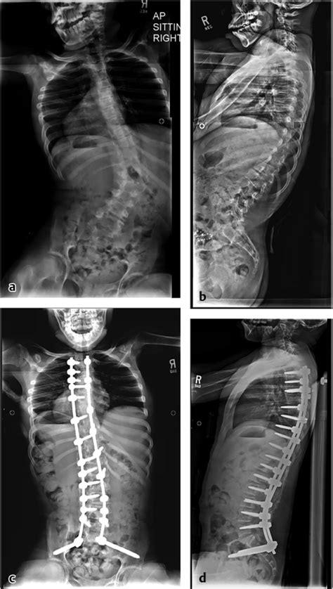 Neuromuscular Scoliosis Thoracic Key