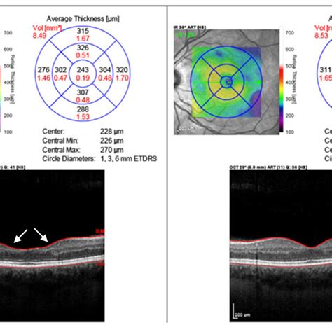 Cirrus Macula Octa Imaging Of The Right Eye Left Image And Left Eye Download Scientific