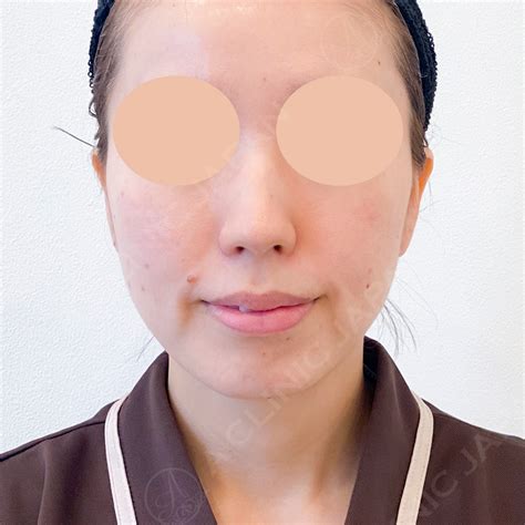 脂肪吸引の直後なのに腫れやダウンタイムを感じません！1day小顔脂肪吸引の処置前と処置直後の症例です30代女性 顔の脂肪吸引・糸リフト