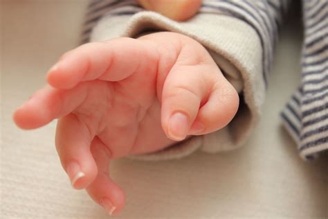 Polidactilia O Que é Sintomas Causas Tipos E Tratamento Tua Saúde