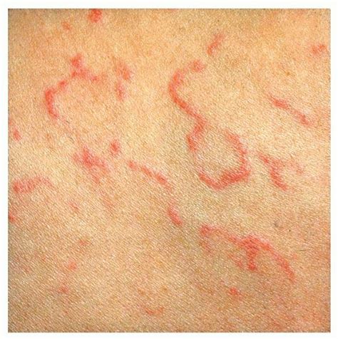 Erythema Marginatum Picture