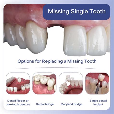 Options For Replacing Missing Single Tooth Hackensack Bergen County Nj
