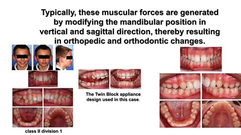 Removable Functional Appliance 1 Pptx
